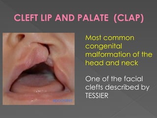Naso-Alveolar-Moulding-for-Cleft-Lip-and-Palate.pptxkjhvkjhvh | PPTX
