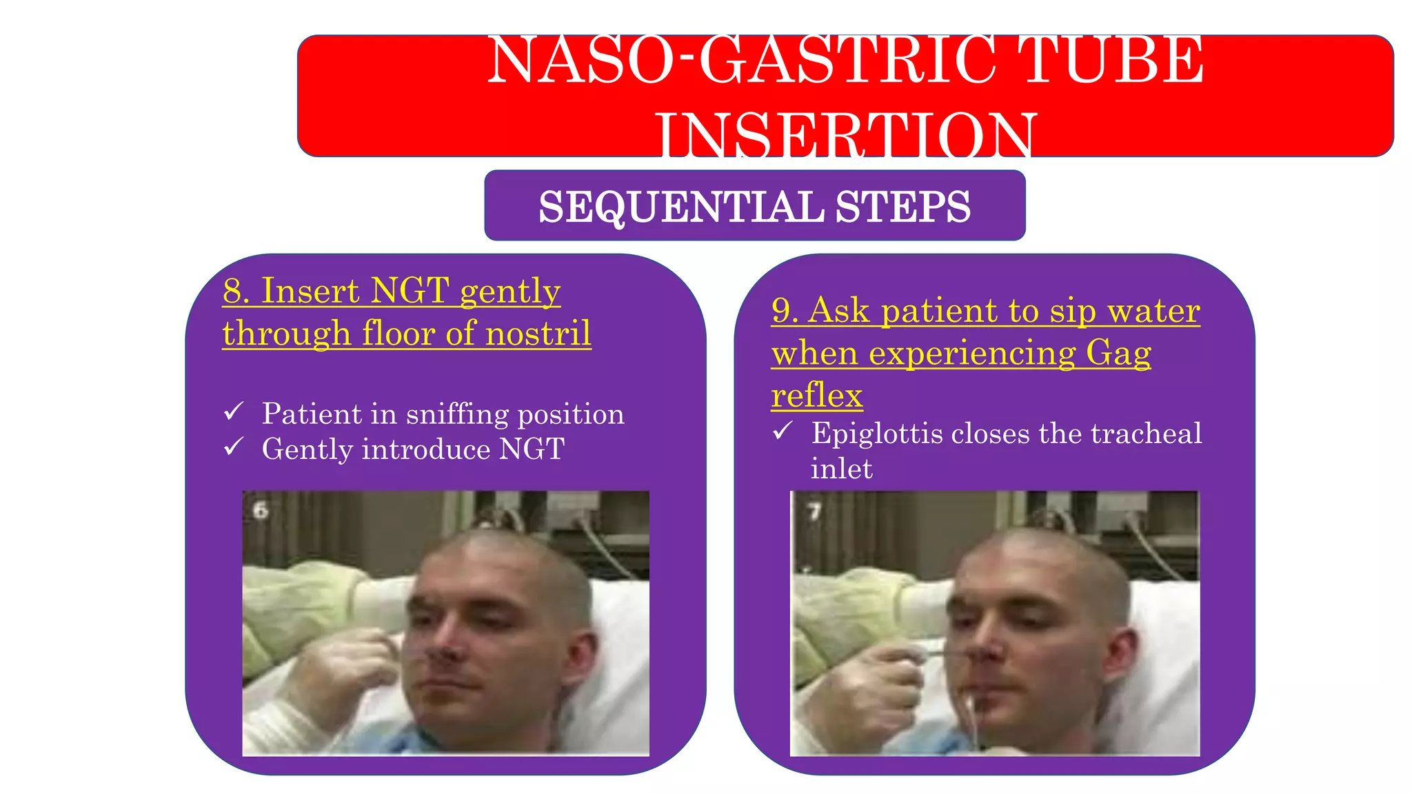 Naso gastric tube insertion- skill lab- osce | PPTX