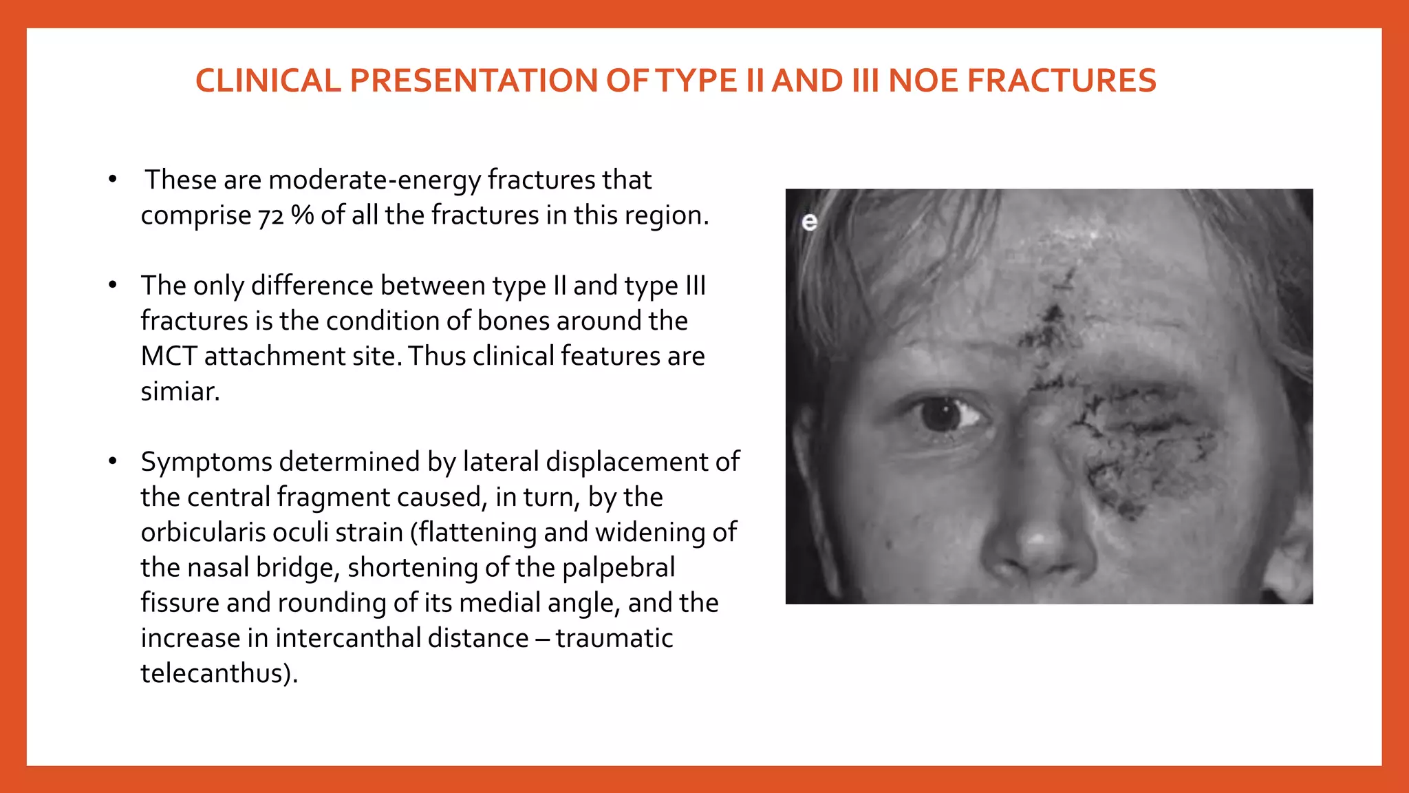 Naso orbito-ethmoid fractures | PPTX