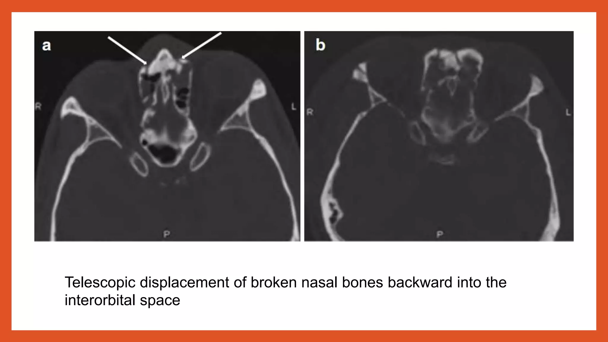 Naso orbito-ethmoid fractures | PPTX