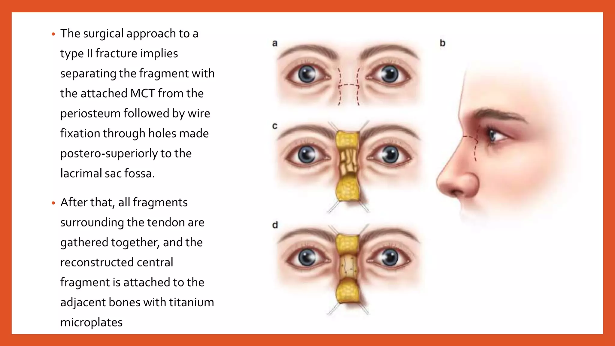Naso orbito-ethmoid fractures | PPTX