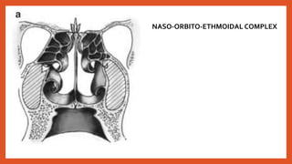 Naso orbito-ethmoid fractures | PPTX
