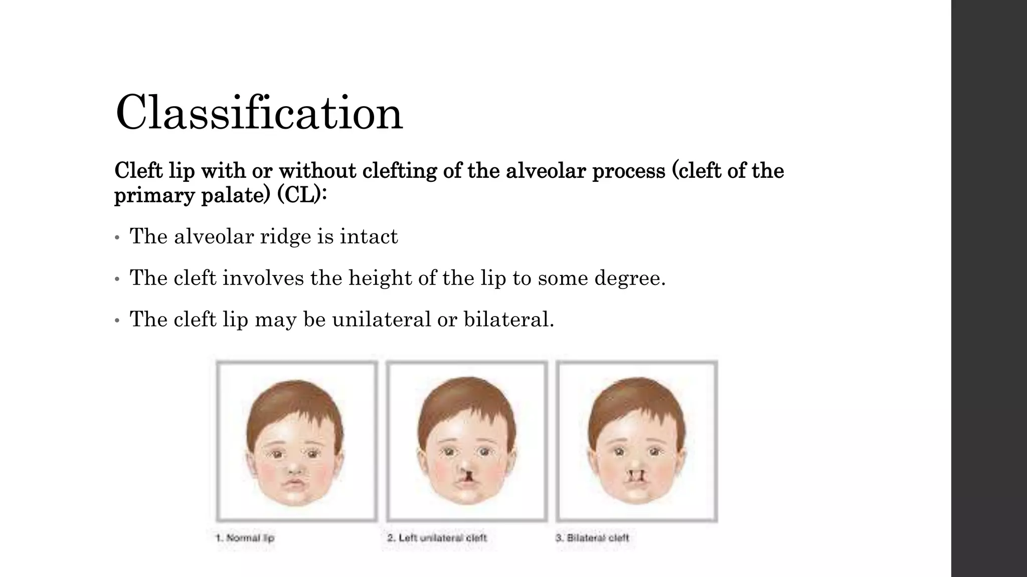 Naso alveolar molding treatment protocol in patients with cleft | PPTX