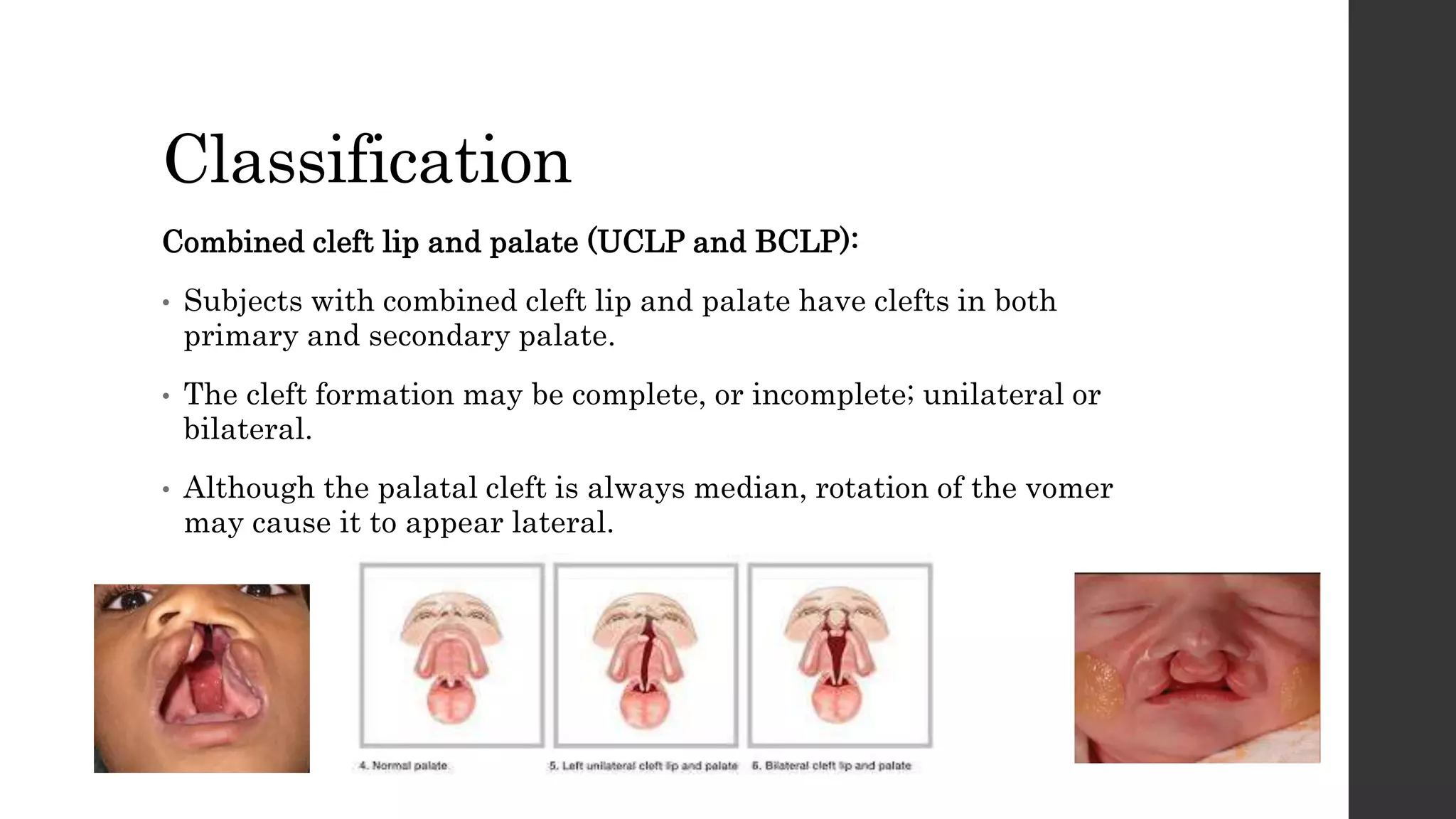 Naso alveolar molding treatment protocol in patients with cleft | PPTX