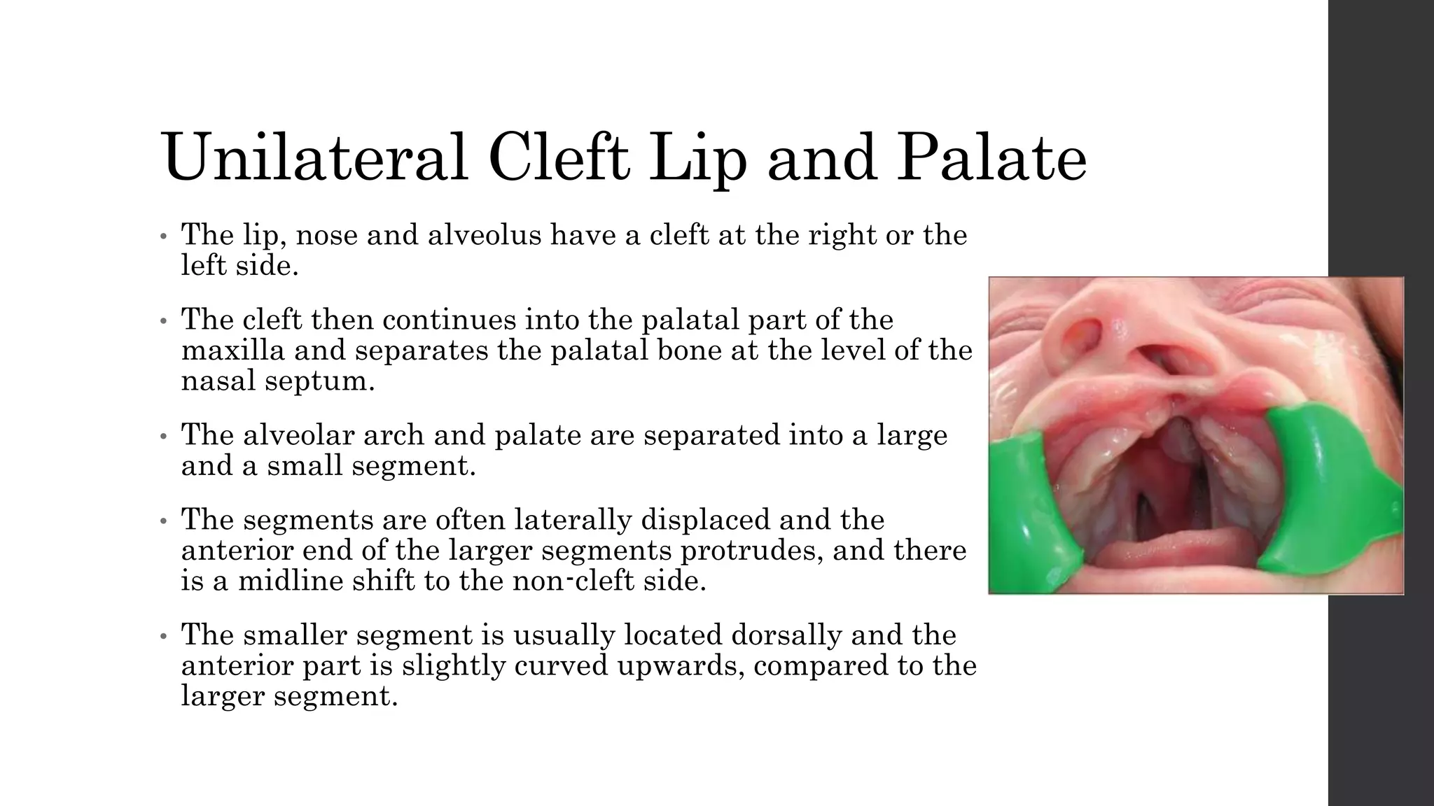 Naso alveolar molding treatment protocol in patients with cleft | PPTX