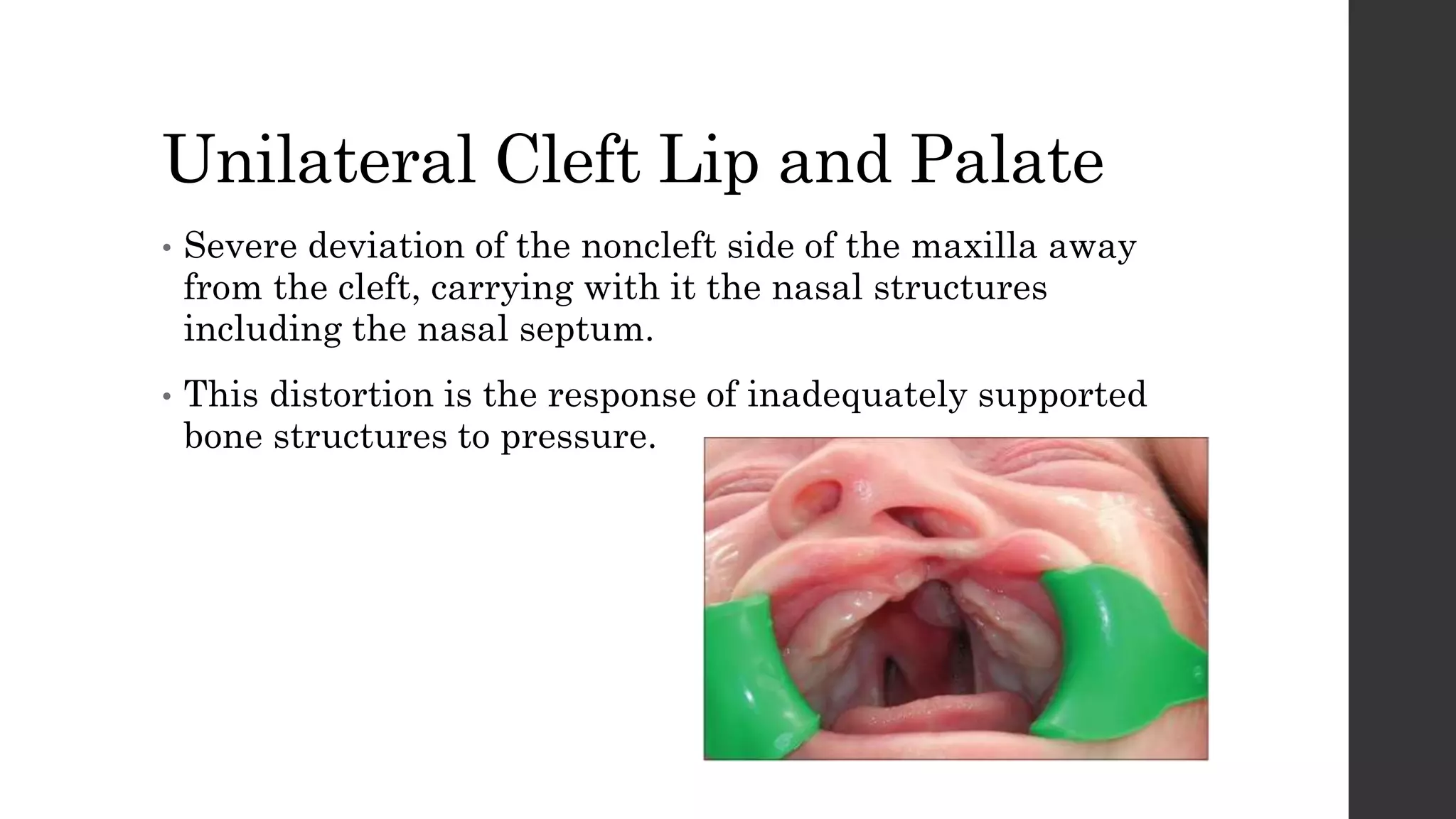 Naso alveolar molding treatment protocol in patients with cleft | PPTX