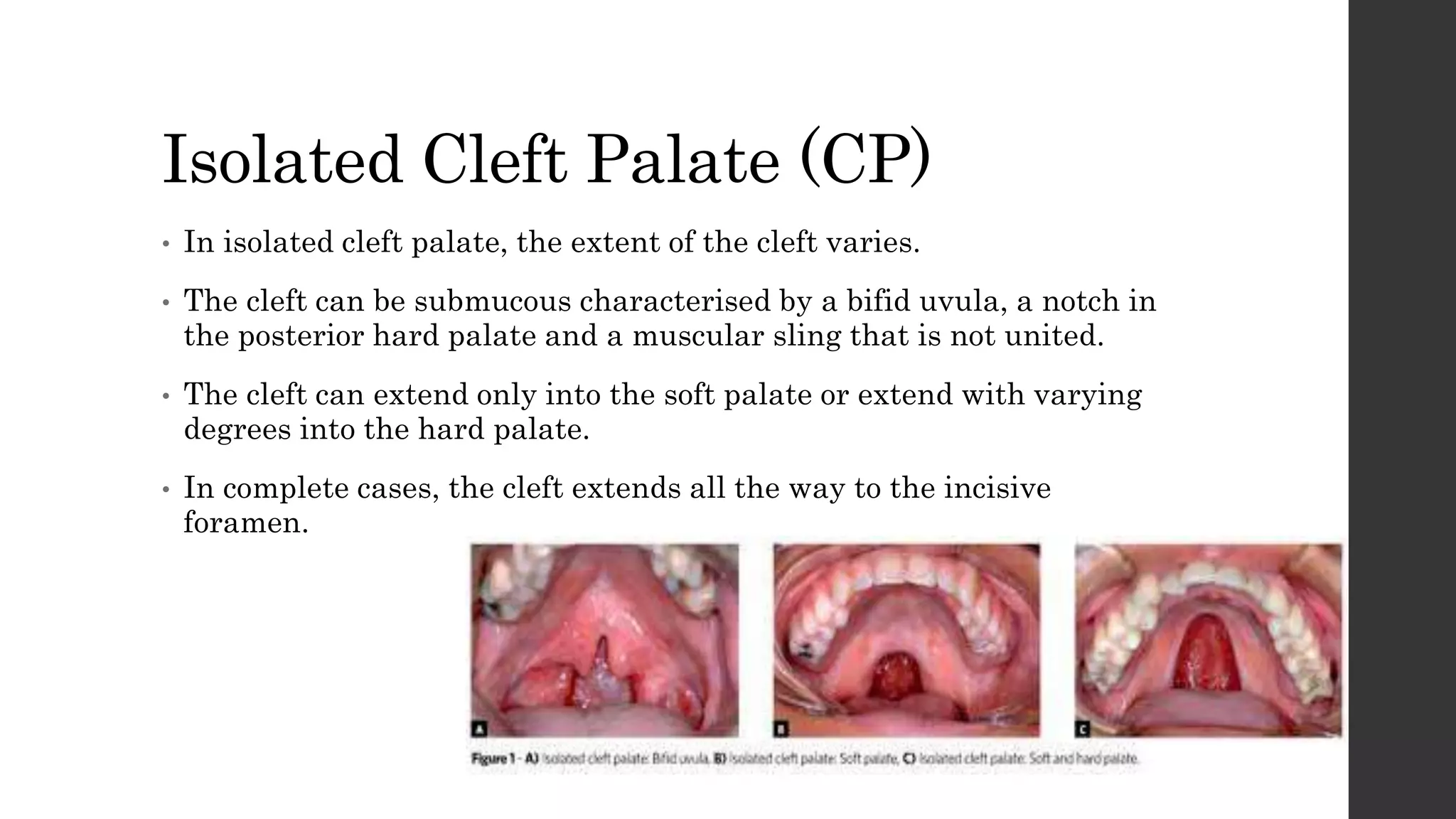 Naso alveolar molding treatment protocol in patients with cleft | PPTX