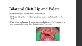 Naso alveolar molding treatment protocol in patients with cleft | PPT