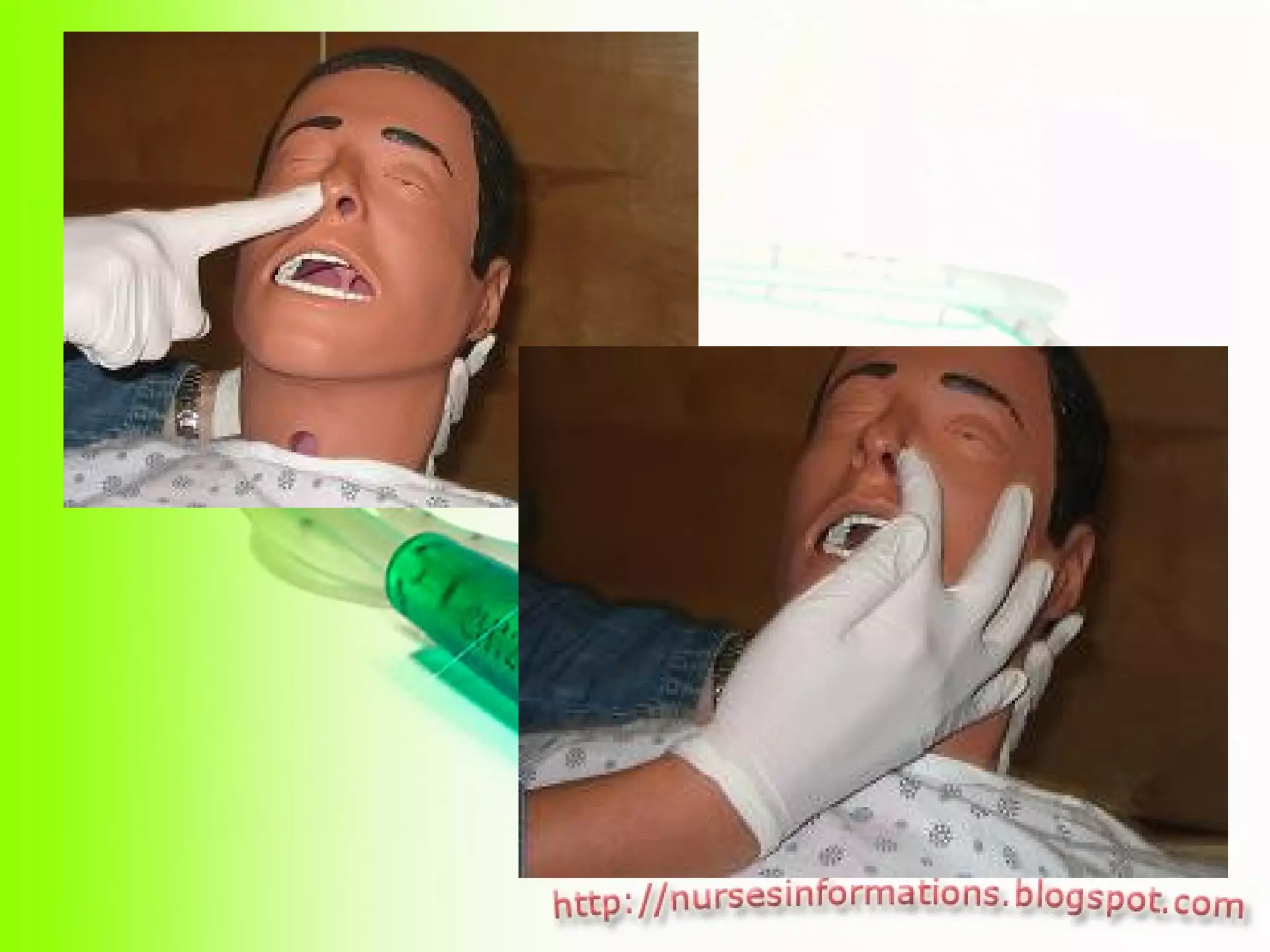 Nasogastric Tube (NGT) insertion and removal | PPS