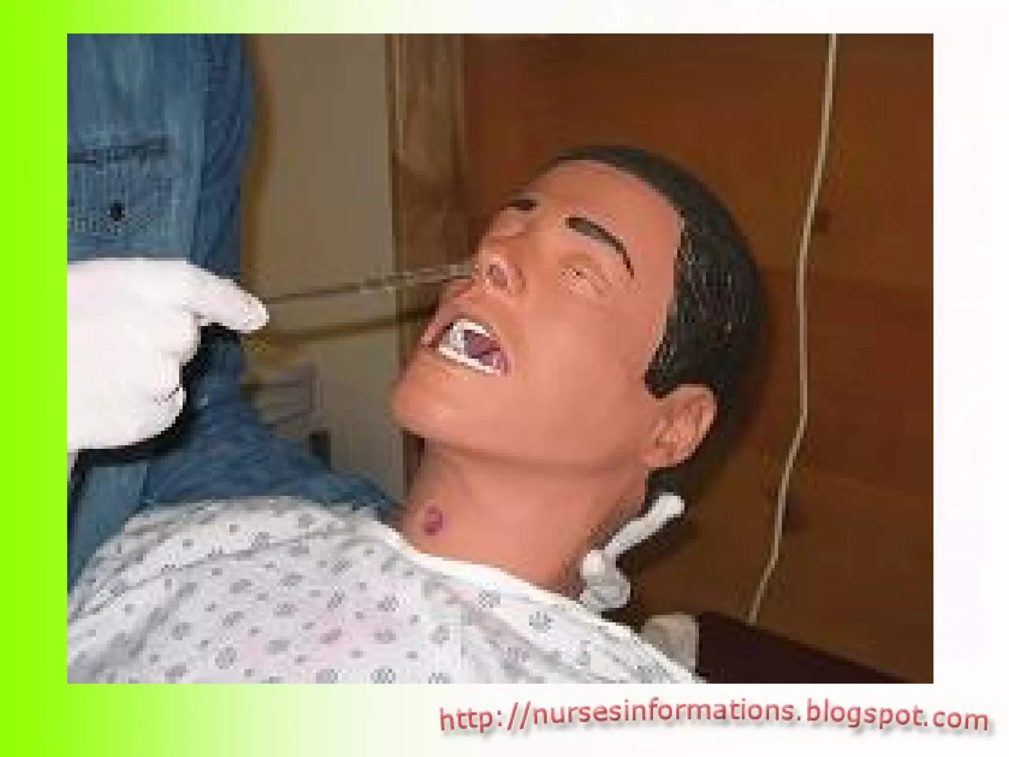 Nasogastric Tube (NGT) insertion and removal | PPS