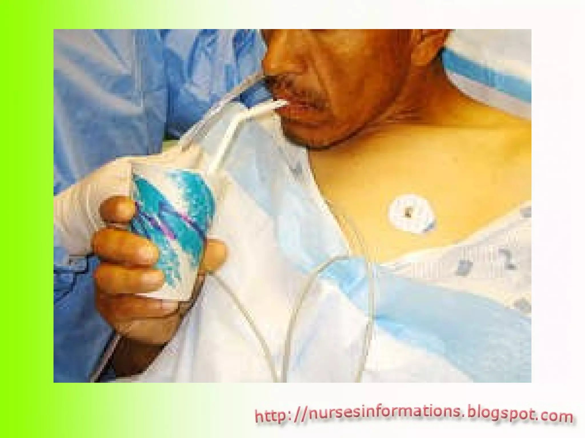 Nasogastric Tube (NGT) insertion and removal | PPS