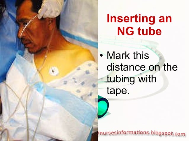 Nasogastric Tube (NGT) insertion and removal | PPS