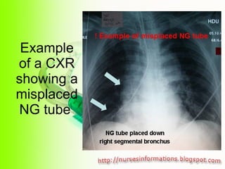 Nasogastric Tube (NGT) insertion and removal | PPS