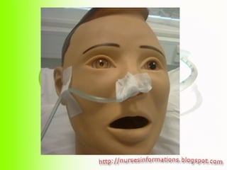 Nasogastric Tube (NGT) insertion and removal | PPS