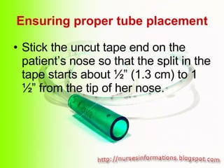 Nasogastric Tube (NGT) insertion and removal | PPS