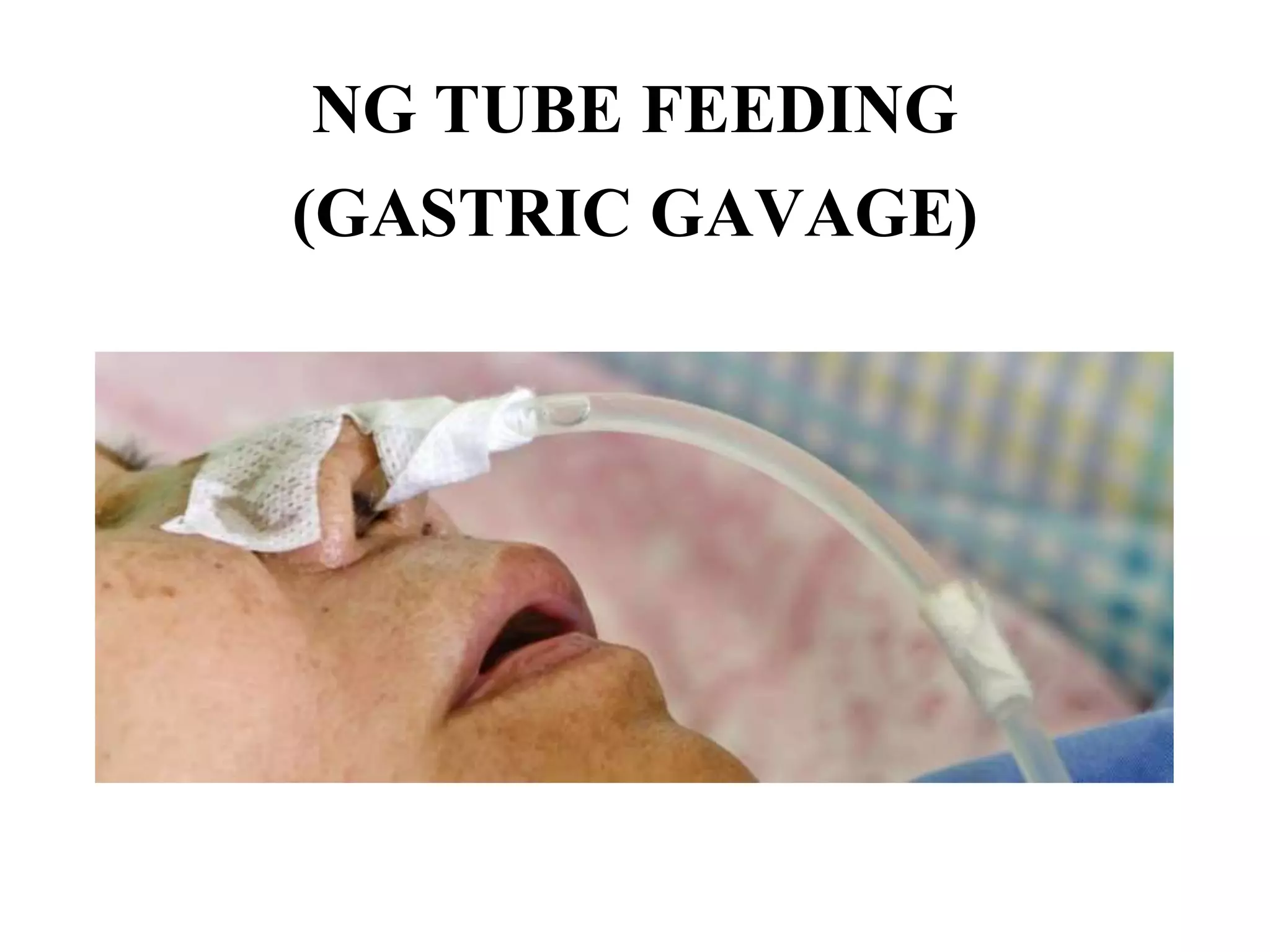 Nasogastric intubation | PPTX