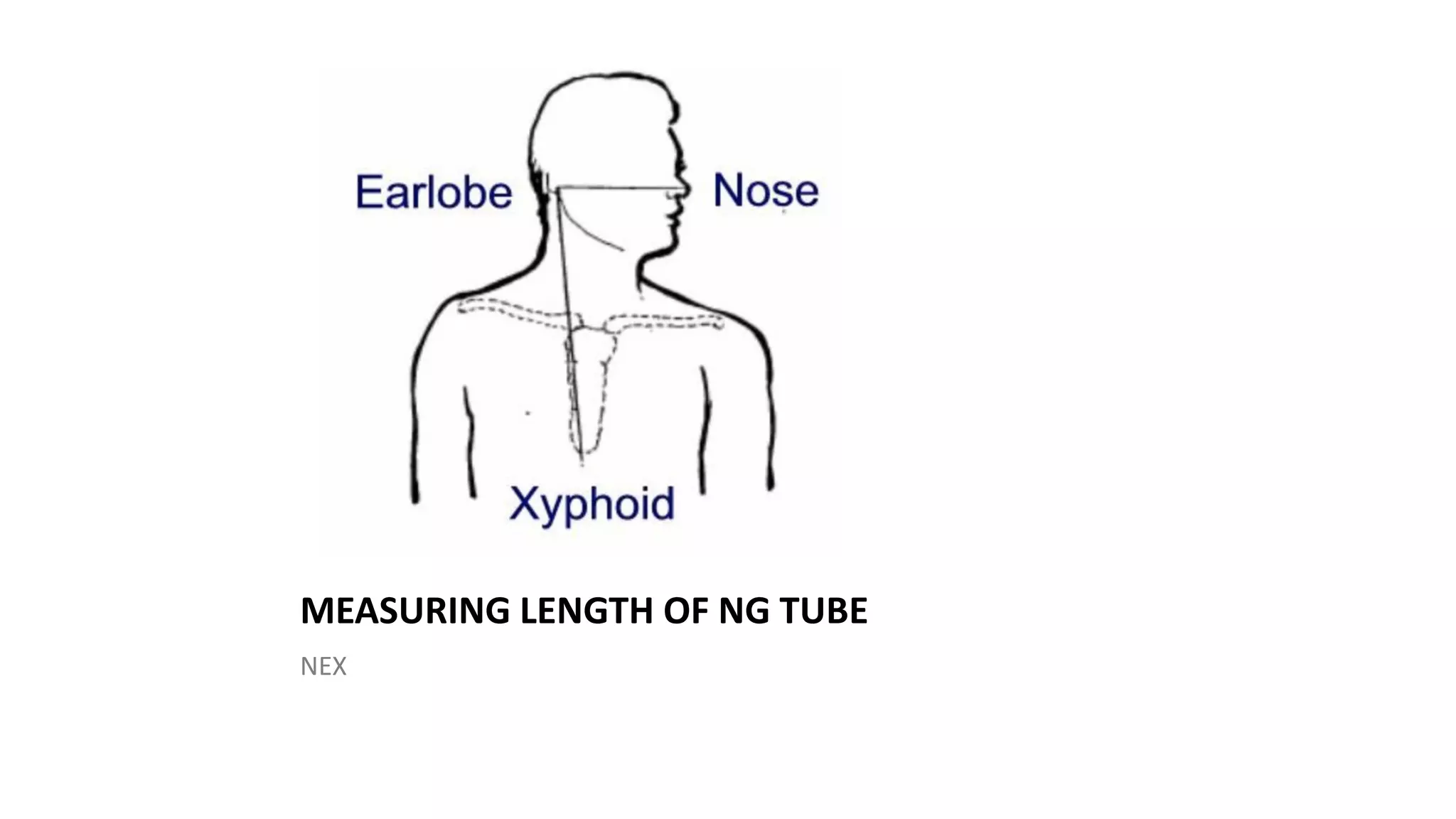 Nasogastric tube | PDF