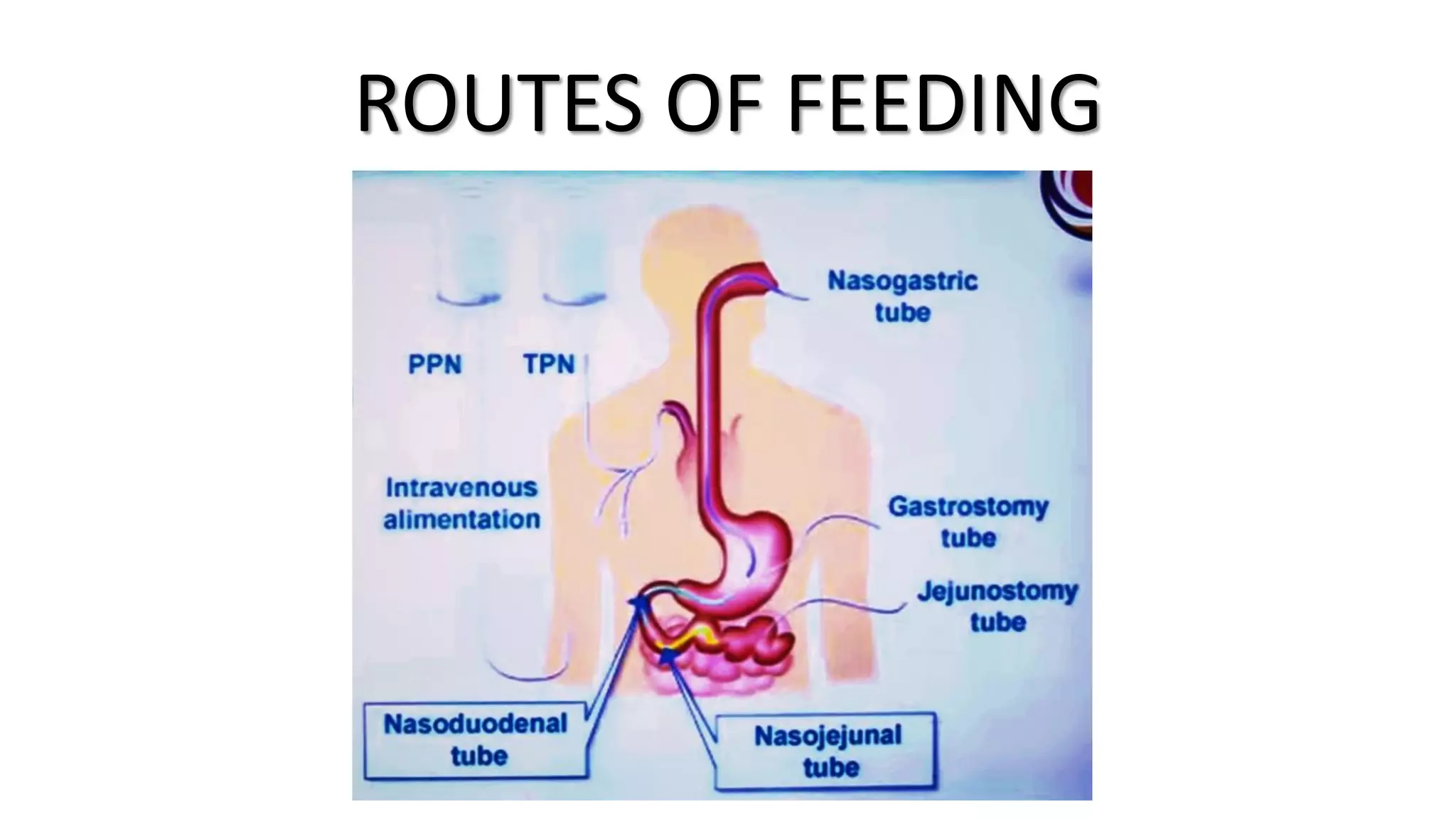 Nasogastric tube | PDF