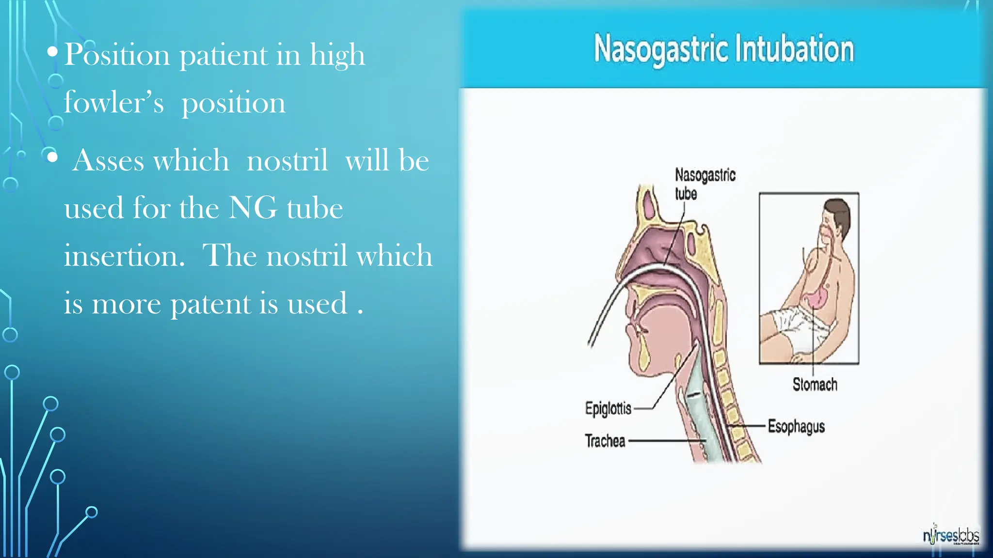 nasogastric tube insertion and nasogastric tube feeding | PPTX