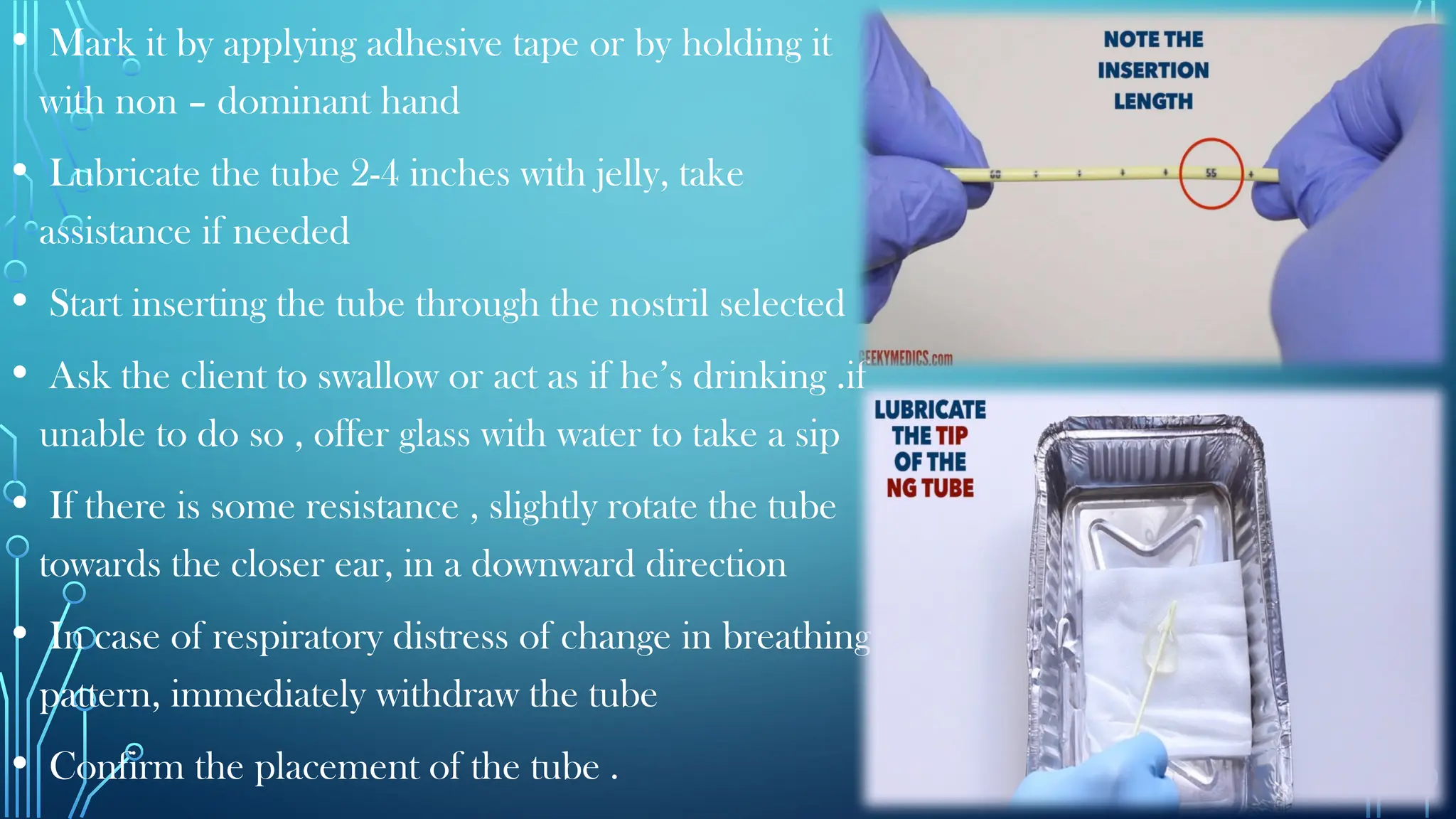 nasogastric tube insertion and nasogastric tube feeding | PPTX