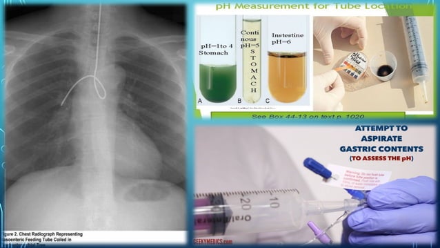 nasogastric tube insertion and nasogastric tube feeding | PPTX