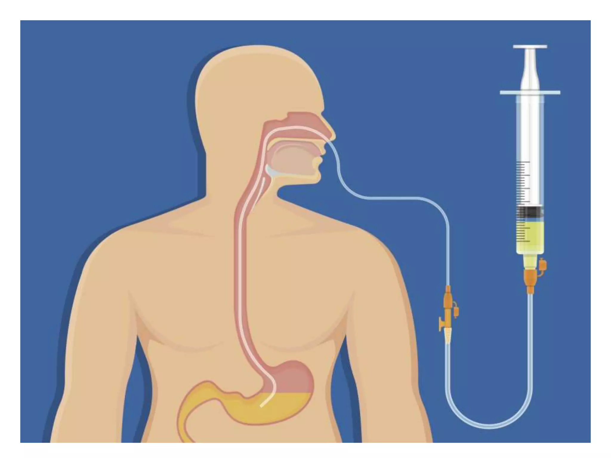 Nasogastric tube feeding.pptx