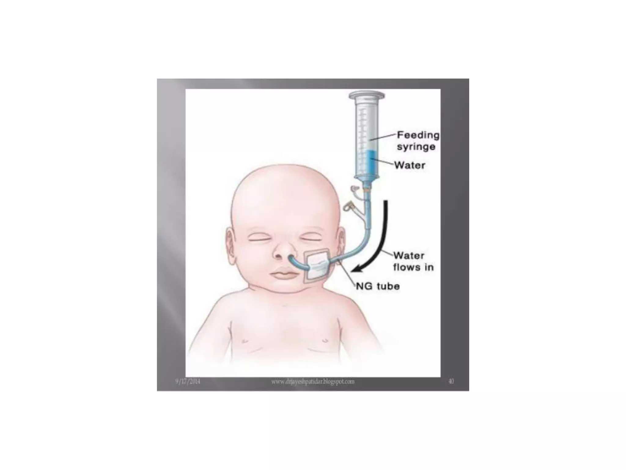 Nasogastric tube feeding.pptx