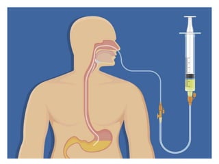 Nasogastric tube feeding.pptx