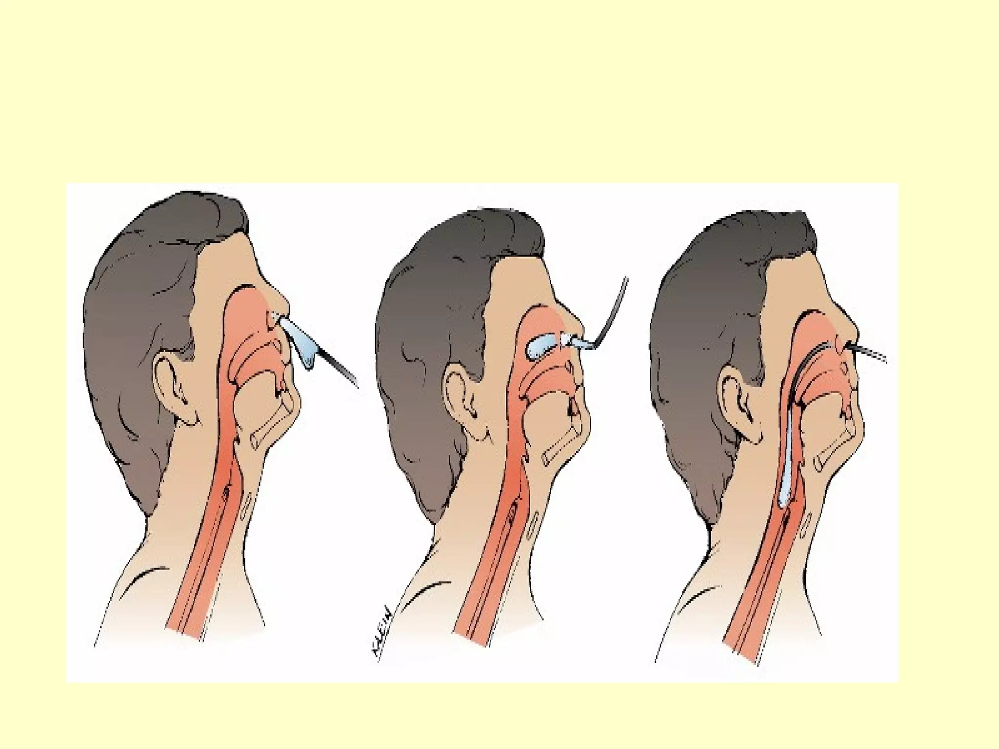 Nasogastric tube insertion | PPT