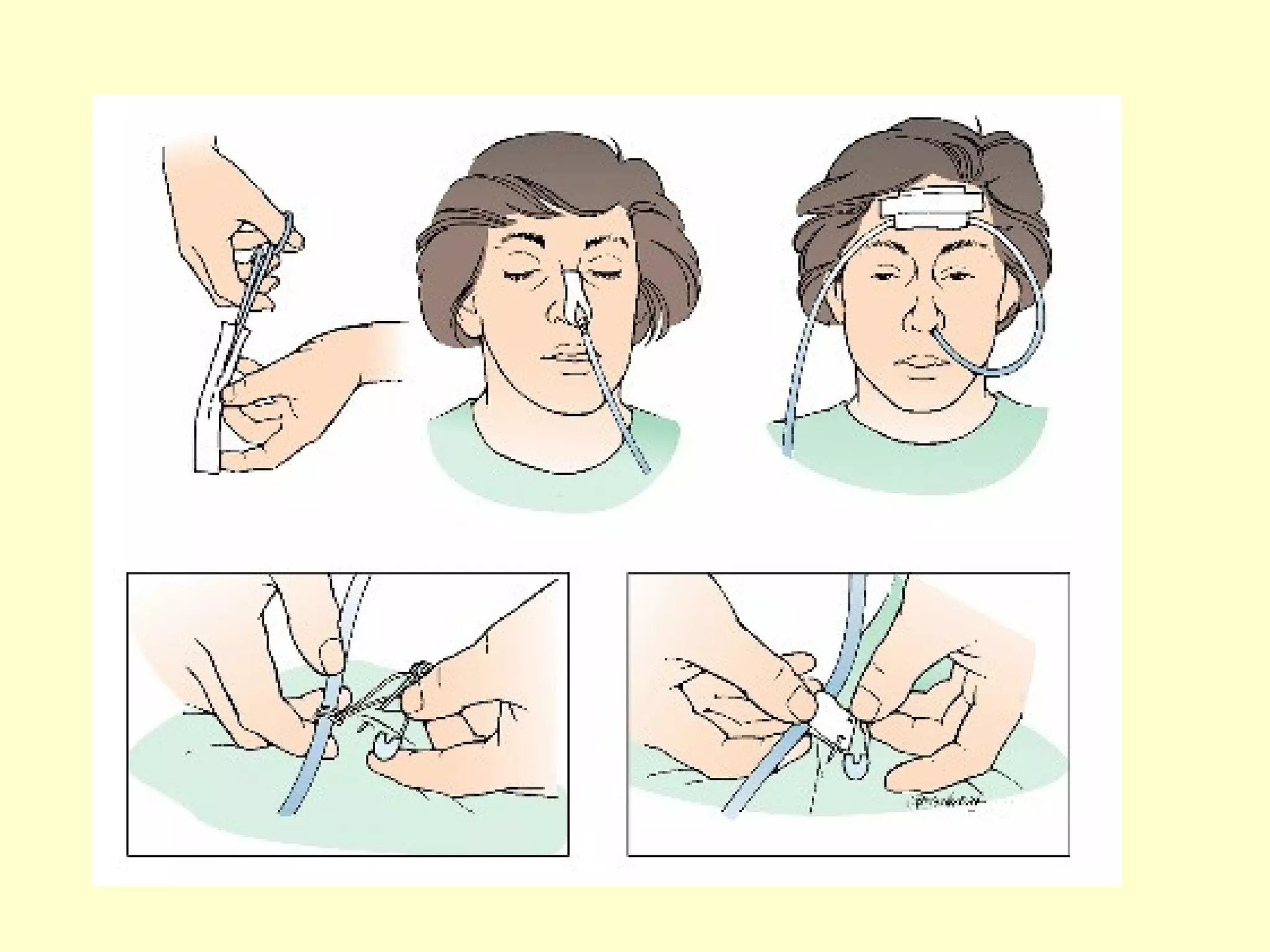 Nasogastric tube insertion | PPT
