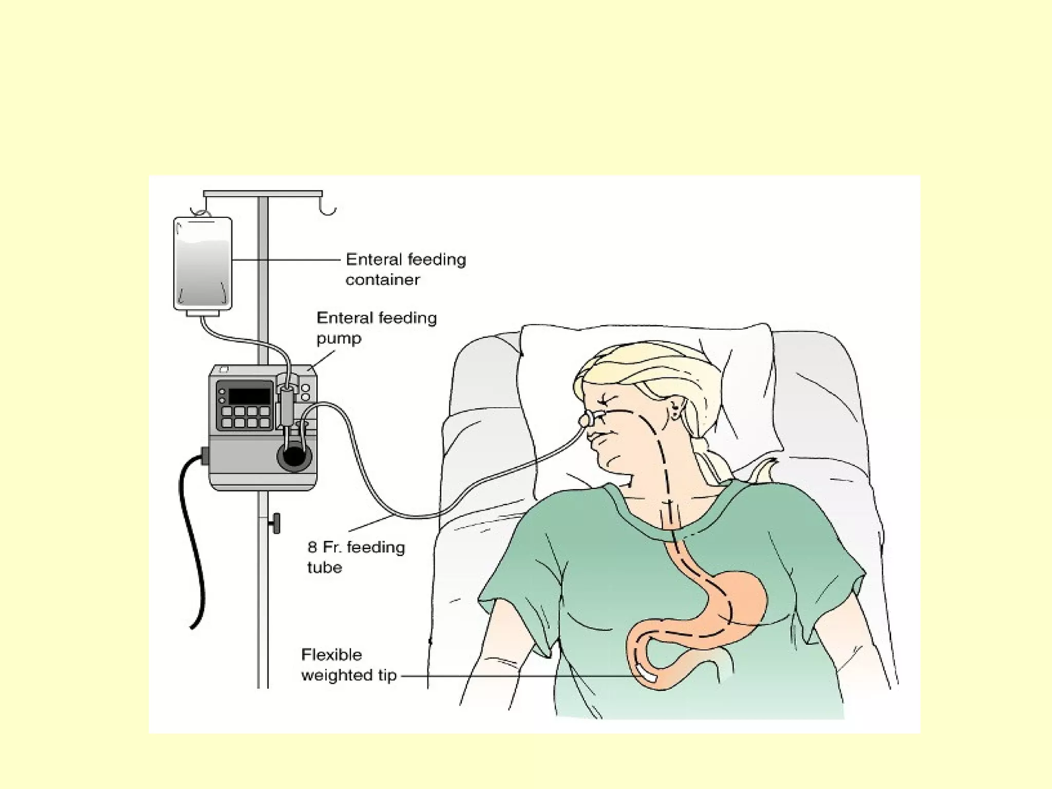 Nasogastric tube insertion | PPT