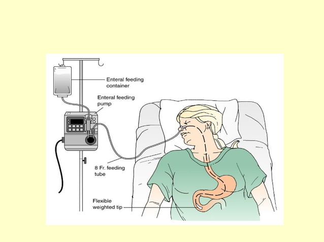 Nasogastric tube insertion | PPT