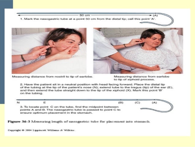 Nasogastric tube insertion