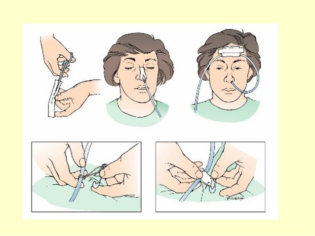 Nasogastric tube insertion