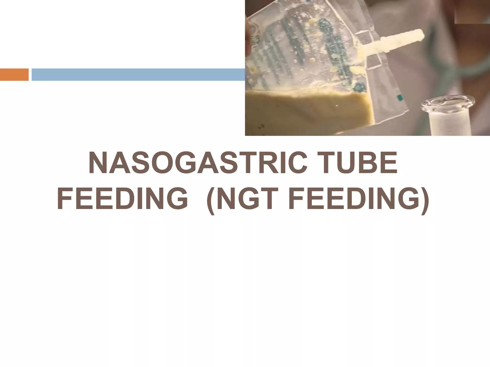 Nasogastric tube insertion and feeding | PPTX