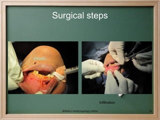 Nasolabial cyst | ODP