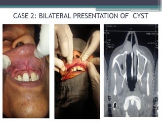 NASOLABIAL CYST.pptx and it’s mangment ,excision | PPTX