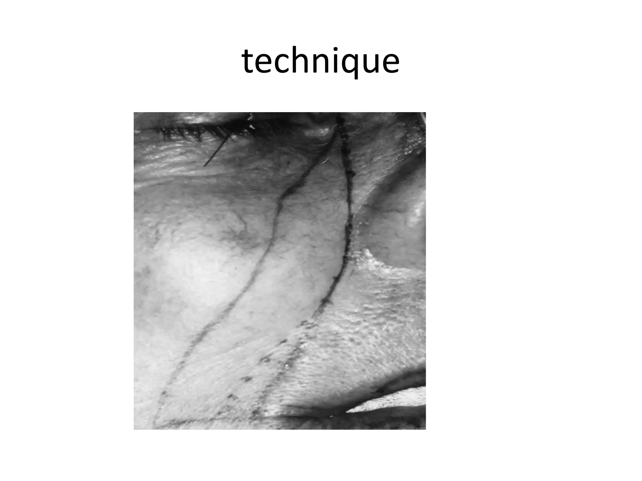 Nasolabial flap final | PPTX