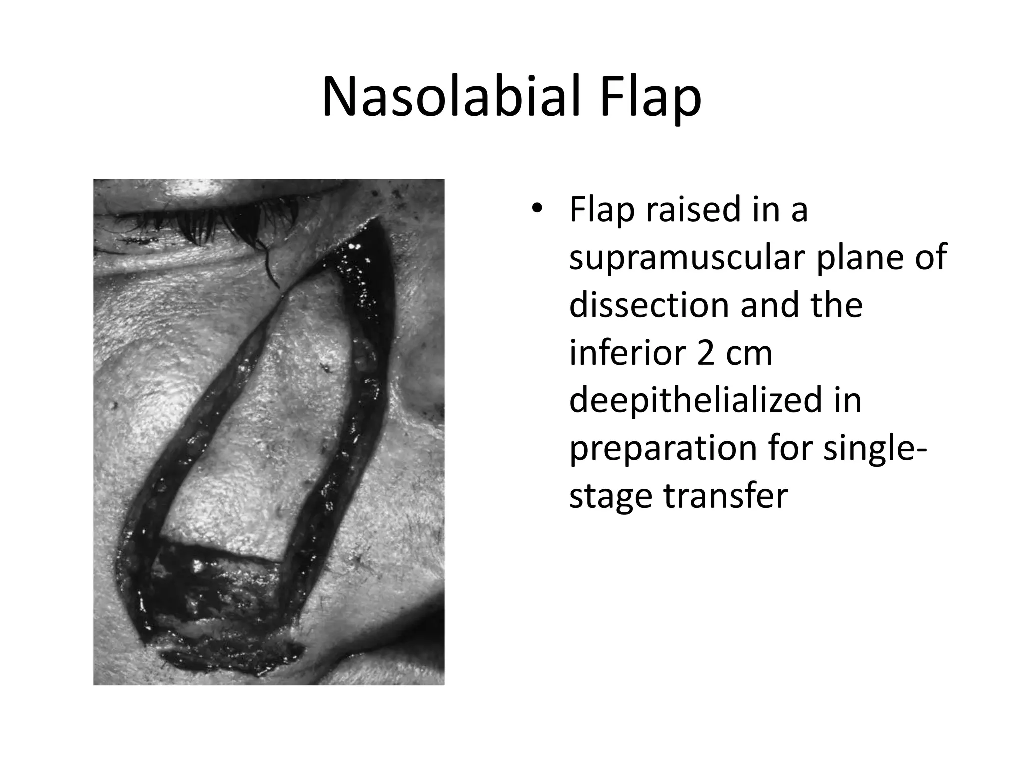 Nasolabial flap final | PPTX
