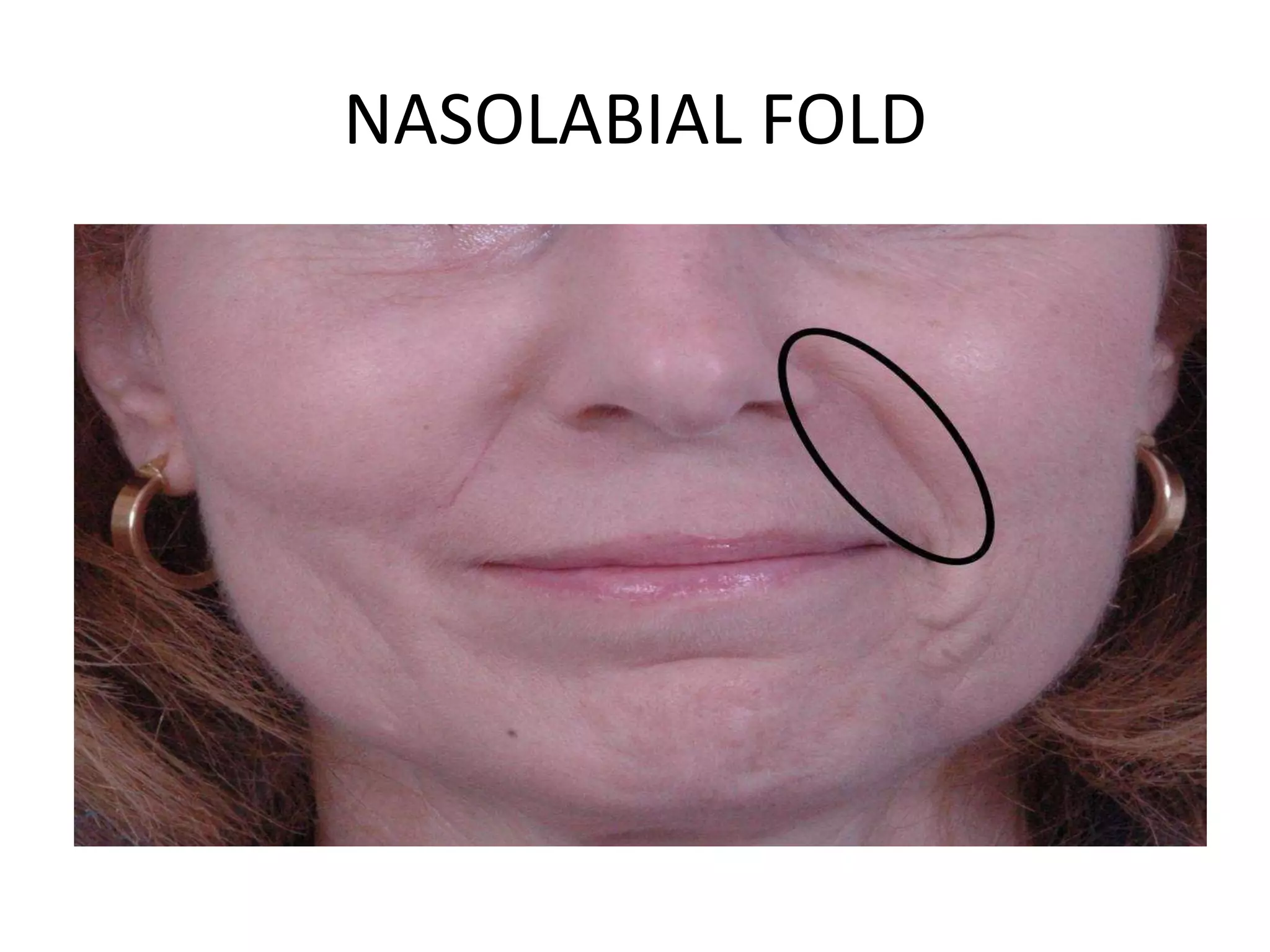 Nasolabial flap final | PPTX | Death, Injury, or Military Conflict | Sensitive Topics