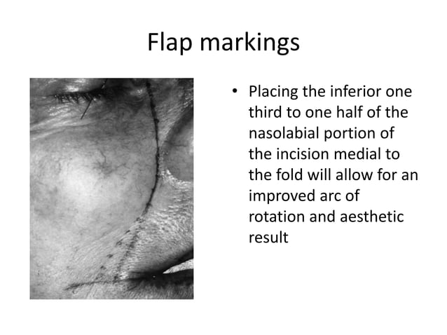 Nasolabial flap final | PPTX | Death, Injury, or Military Conflict ...