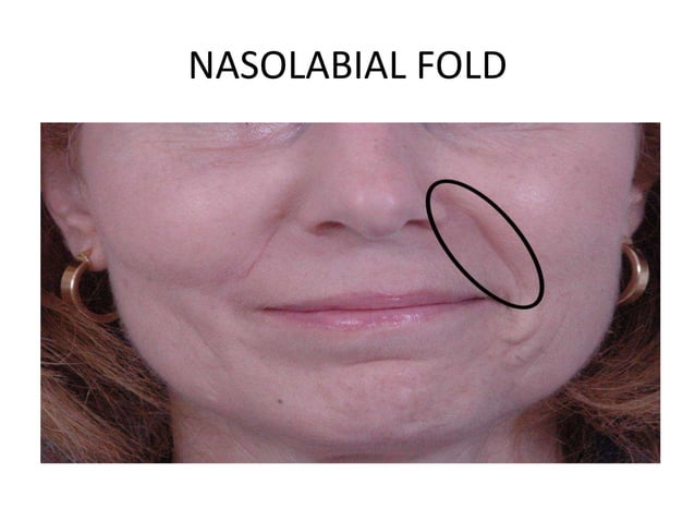 Nasolabial flap final | PPTX | Death, Injury, or Military Conflict ...
