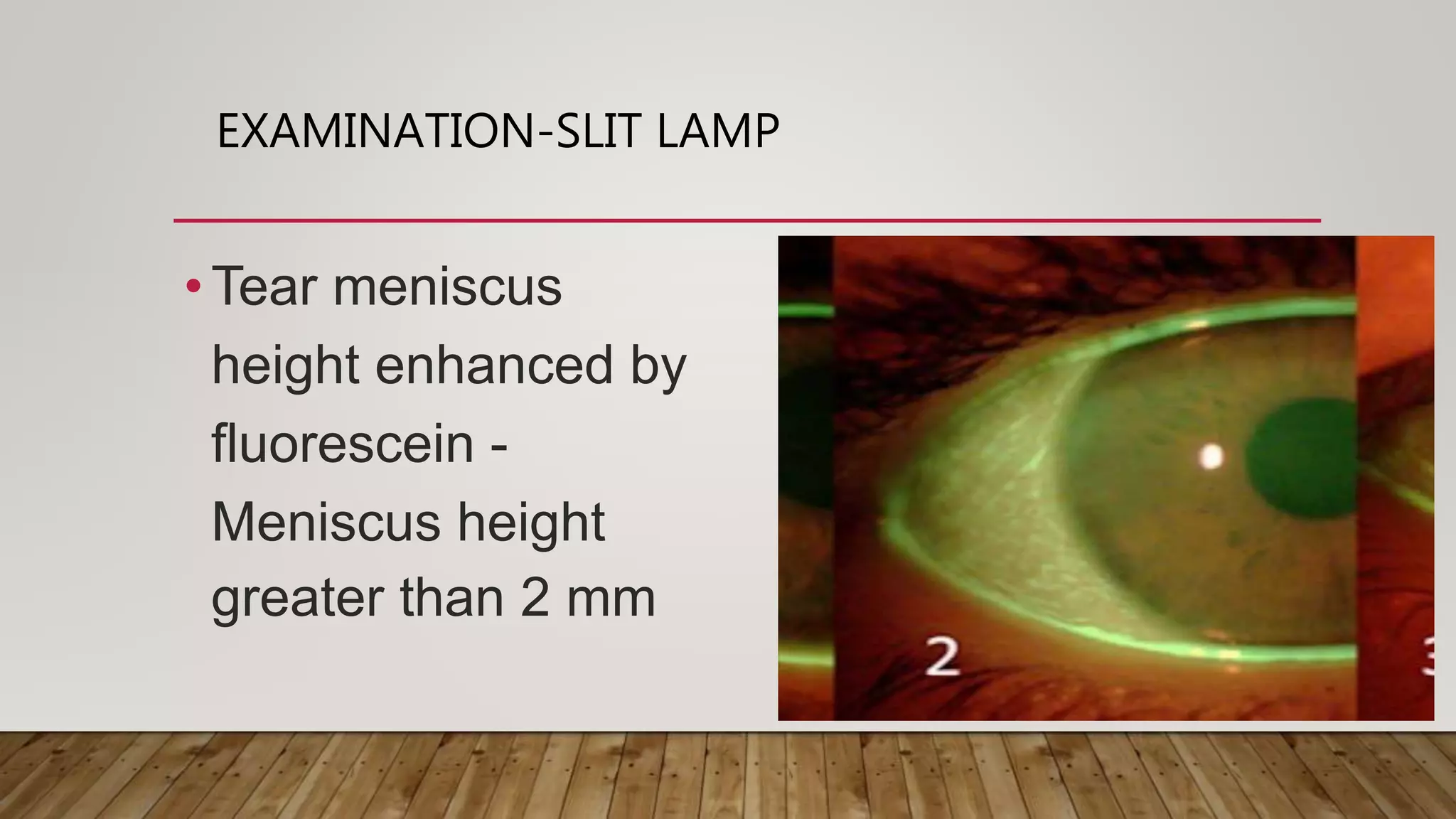 Nasolacrimal duct obstruction | PPT