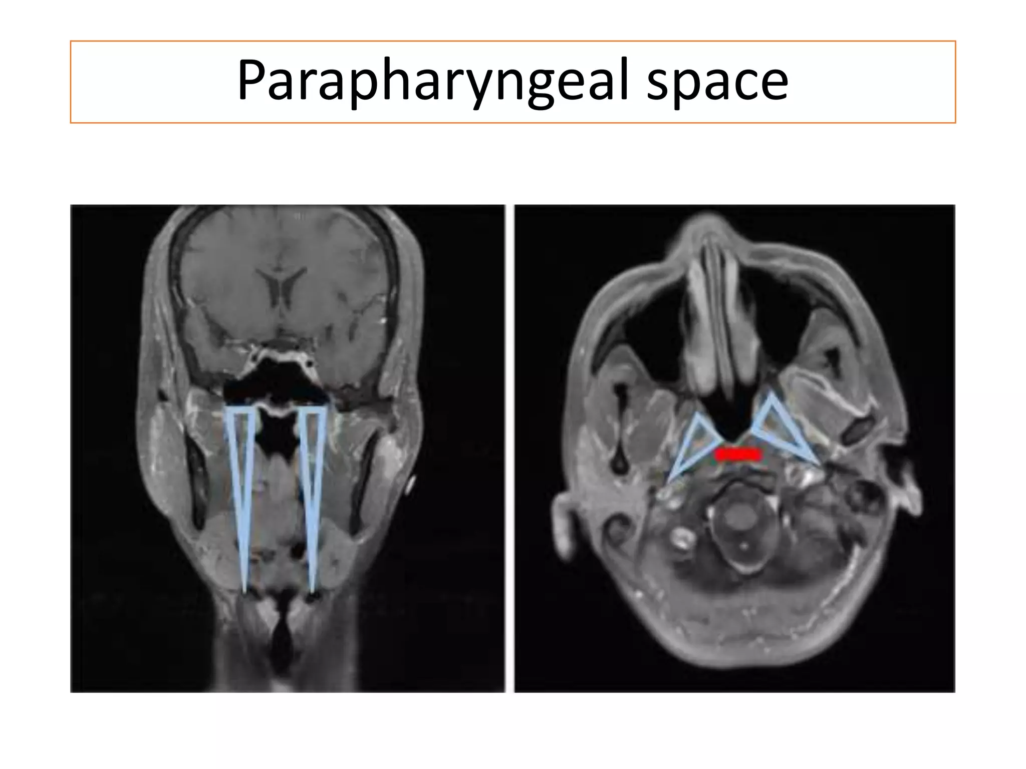 ANATOMY OF NASOPHARYNX AND STAGING CORRELATION | PPTX
