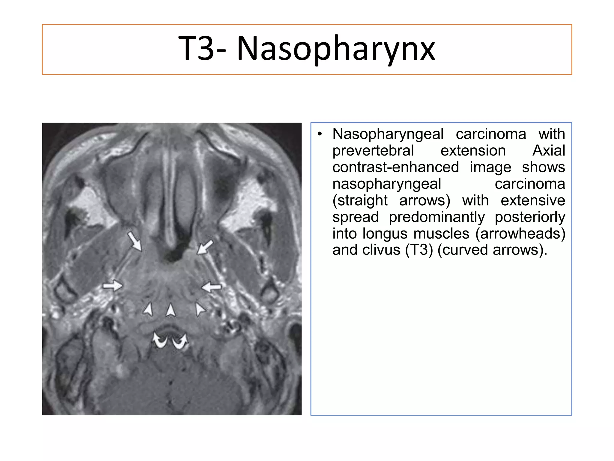 ANATOMY OF NASOPHARYNX AND STAGING CORRELATION | PPTX