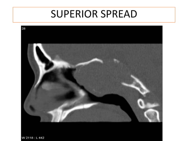 ANATOMY OF NASOPHARYNX AND STAGING CORRELATION | PPTX | Ear, Nose and ...