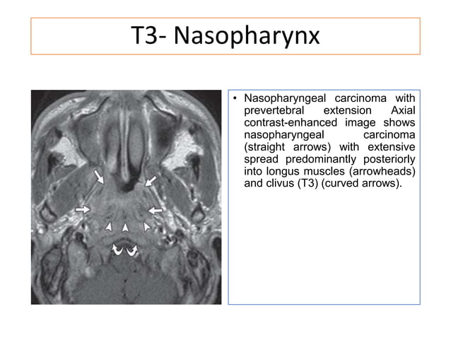 ANATOMY OF NASOPHARYNX AND STAGING CORRELATION | PPTX | Ear, Nose and ...