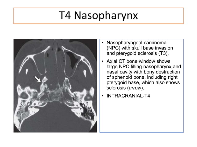 ANATOMY OF NASOPHARYNX AND STAGING CORRELATION | PPTX | Ear, Nose and ...