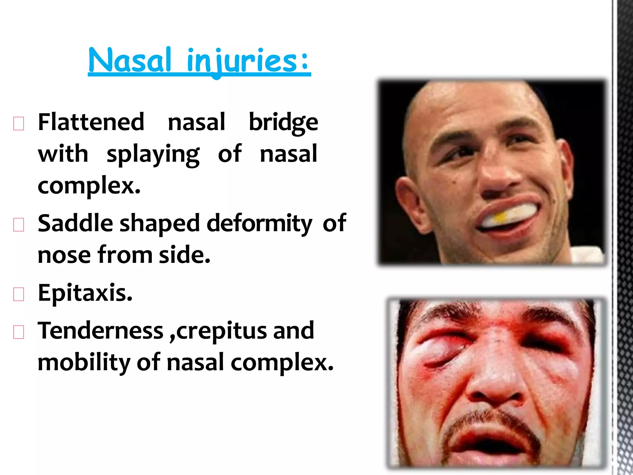 NOE FRACTURE PPT | PPTX