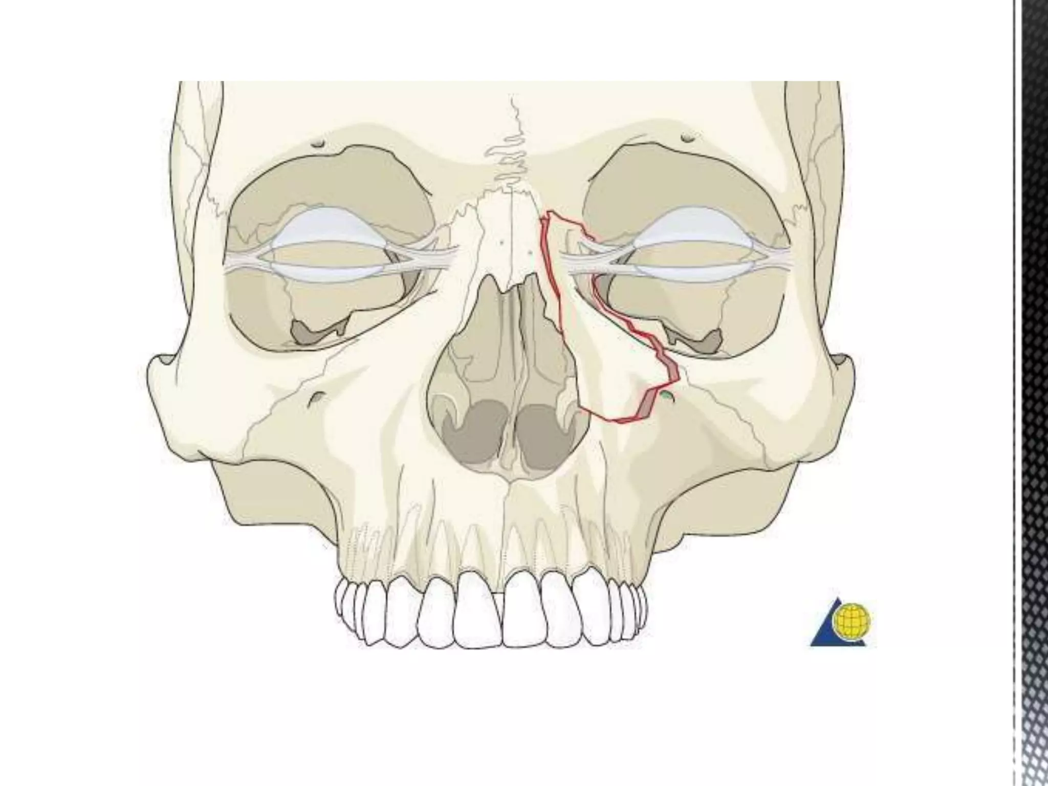 NOE FRACTURE PPT | PPTX
